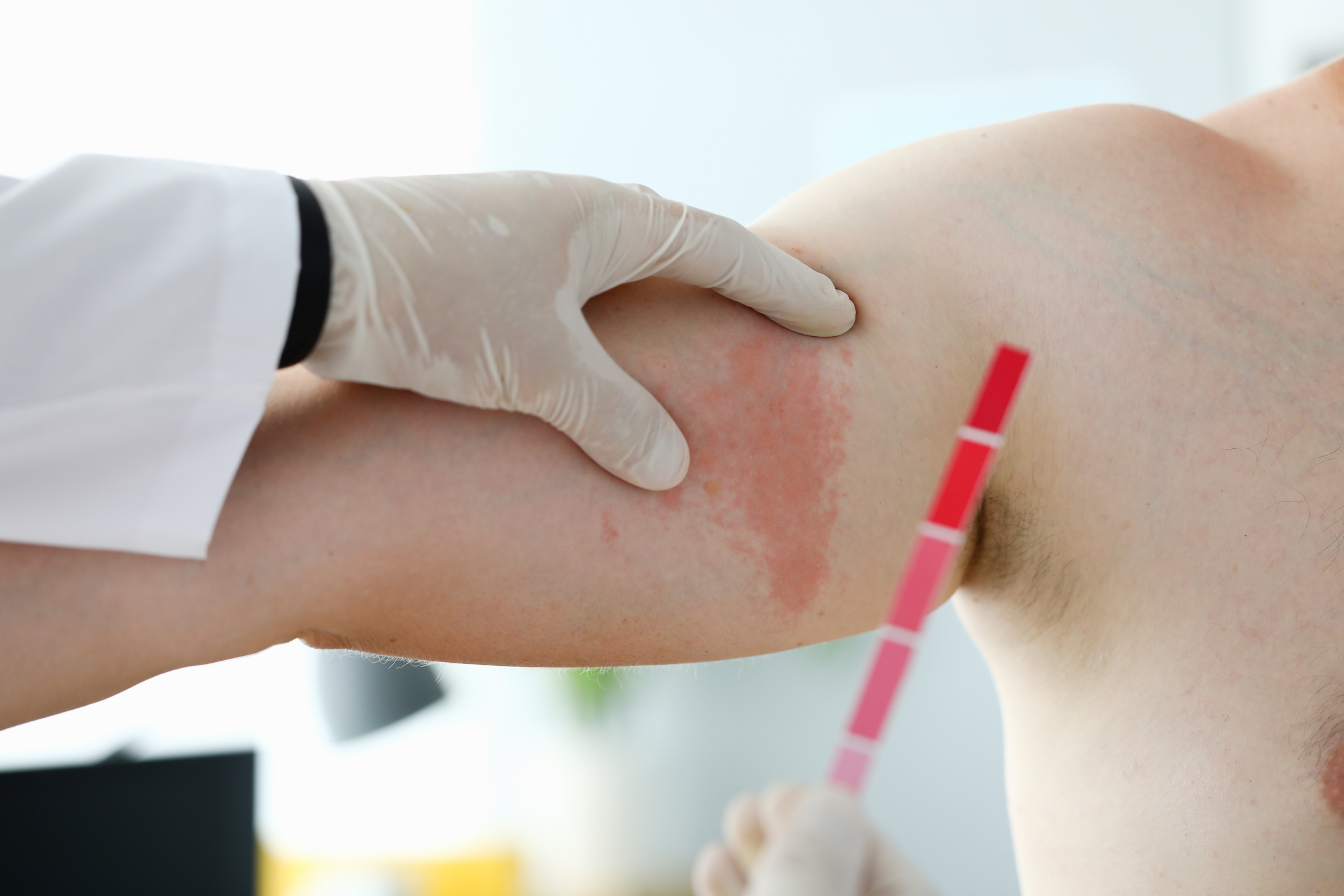 24 avril 2023 – L'Allergie aux Acariens